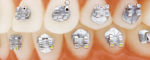 Orthodontie Bracket / Metall - Orthos® - Ormco - Twin