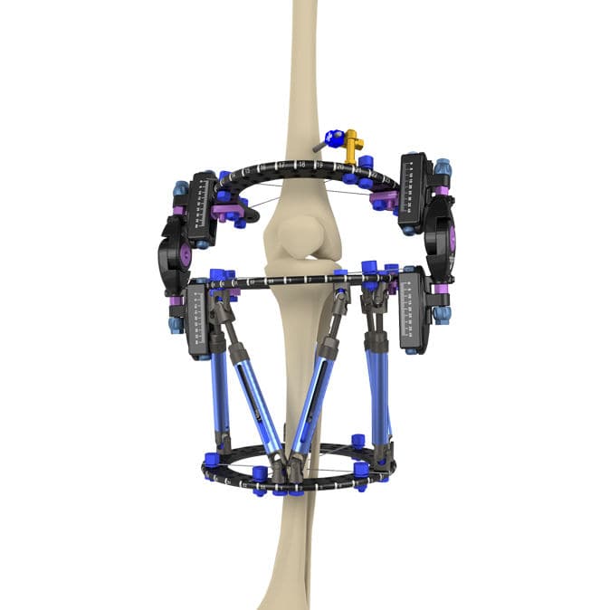 Fixateur externe / Knie - Response Ortho - hybrid / für Erwachsene