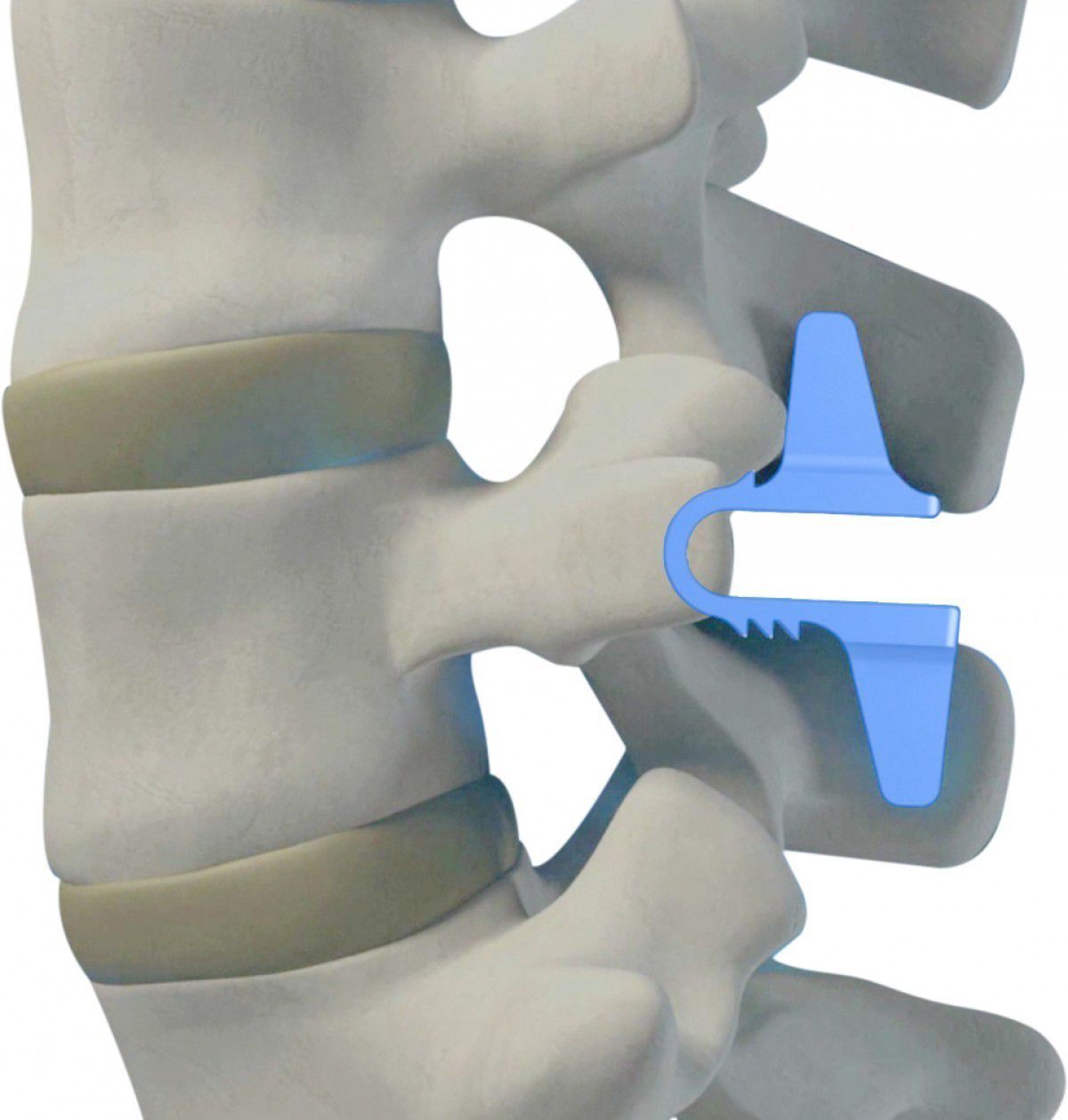 Interspinales Wirbelkörperimplantat / LWS - coflex® - RTI Surgical