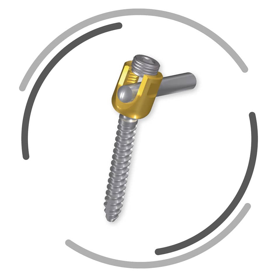 Thorako-lumbale pedikuläre Schraube - MONOPOLY II - Signus Medical ...