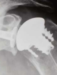 Humeruskopfprothese - EASYTECH™ - FX Solutions