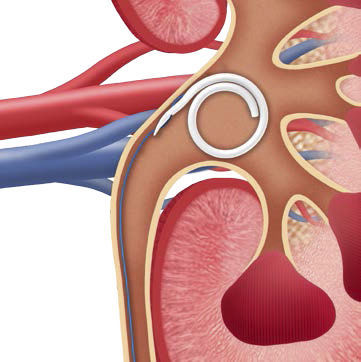 Ureter-Stent - MiniJFil® - ROCAMED - Nitinol