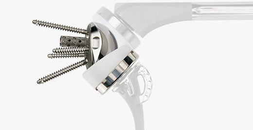 Inverse Schulterprothese - Equinoxe Reverse - Exactech