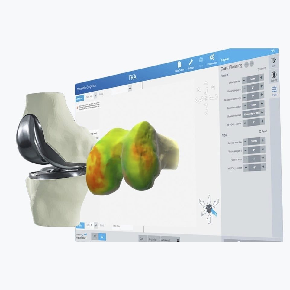 OP-Software - Materialise UK - präoperativ / 3D-Visualisierung / Planung