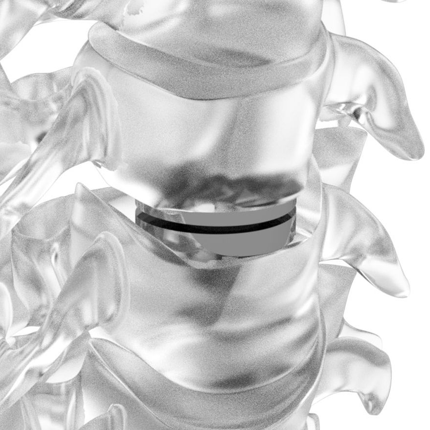 HWS-Wirbelknochenersatz - DYNALIS-C® - NEURO FRANCE Implants