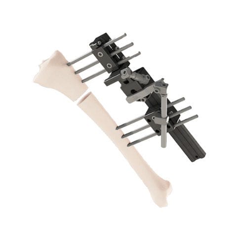 Fixateur externe / für Tibia - Genesis - Selaz - rohrförmig / für ...