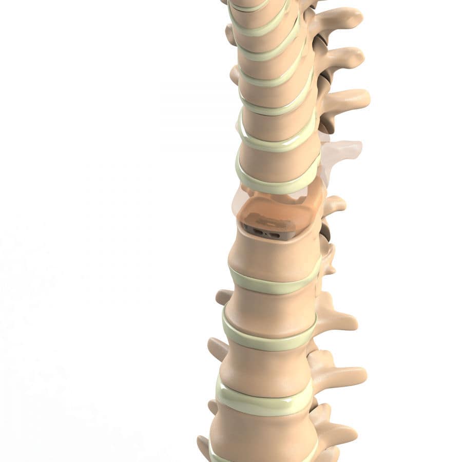 LWS-Zwischenwirbelkäfig - TLIF - Aditus Medical - transforaminal / aus PEEK