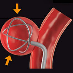 Embolisationsspirale - ED COIL 14 - Kaneka Pharma Europe