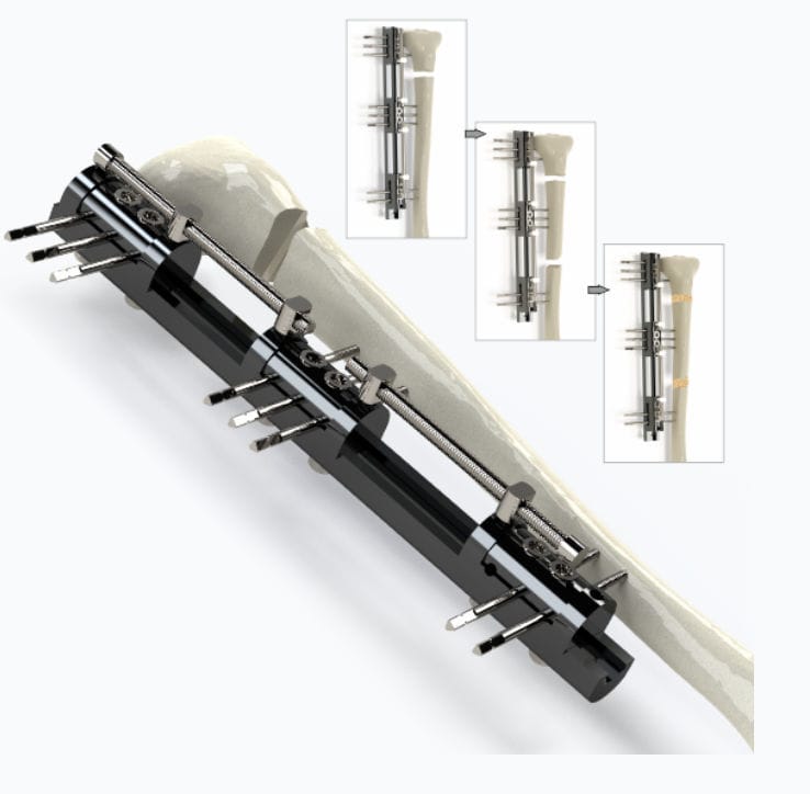 Fixateur externe / für Tibia - 5074 series - Zimed Medical - rohrförmig / für Erwachsene