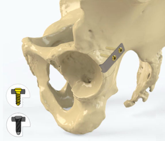 Kompressionsplatte für Acetabulum - Zimed Medical