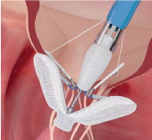 Herz-Reparatursystem / Mitralklappe - PASCAL - Edwards Lifesciences