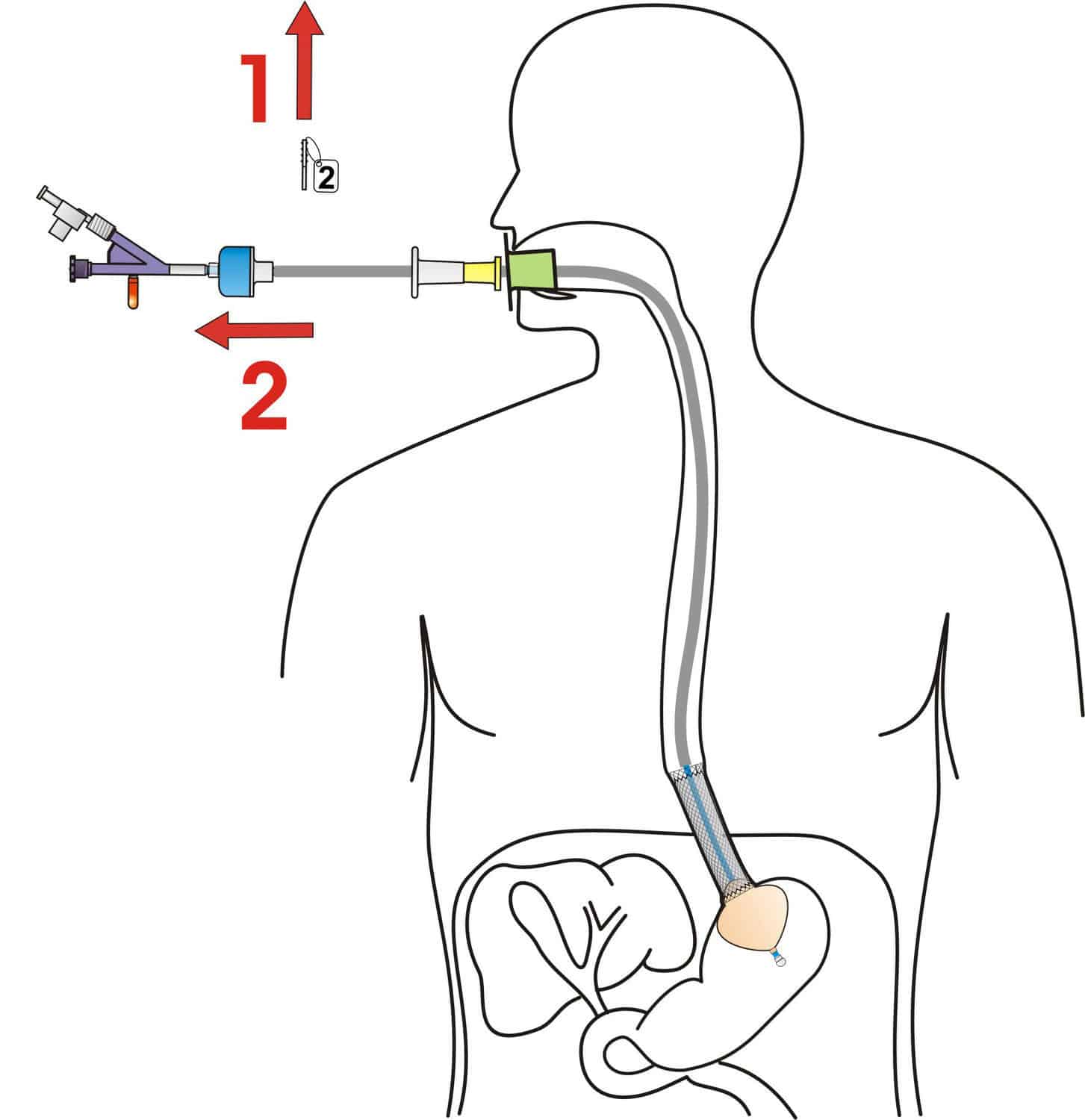 Speiseröhren-Stent - Danis Stent - ELLA-CS - Nitinol / Silikon ...
