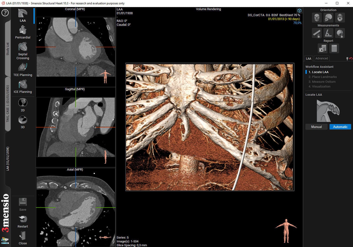 Medizinisches Software-Modul - 3mensio LAA - Pie Medical Imaging ...