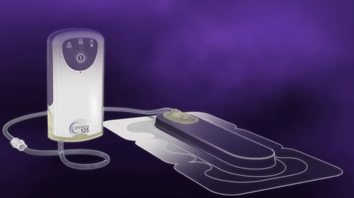 Unterdruck-Wundheilungssystem - Prevena™ - Kinetic Concepts