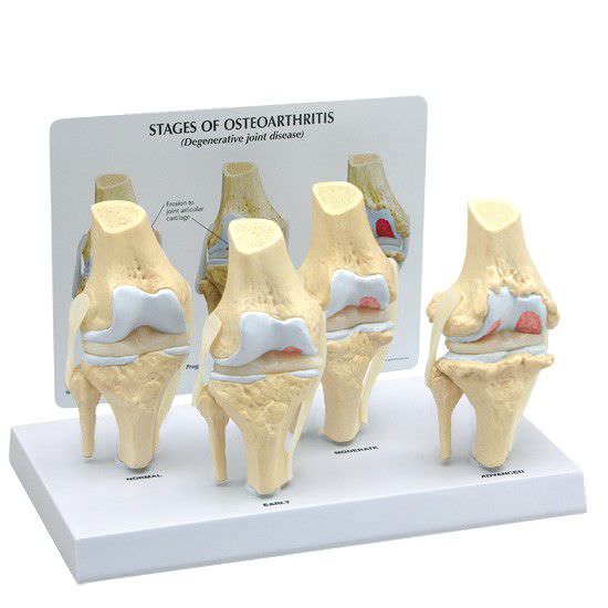 Anatomisches Modell / Gelenk - 1100 - GPI Anatomicals - Knie / Pathologie