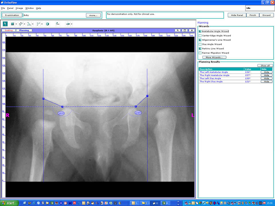 Software / Präoperative Planung - Hip Arthroplasty - OrthoView - für ...