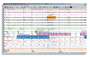 Software für Polysomnografie - SleepWorks™ - Natus Medical - Analyse ...