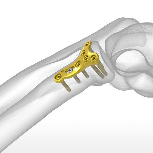 Kompressionsplatte für Radiuskopf - 70-0098 - Acumed - distal / proximal / mit Verriegelung